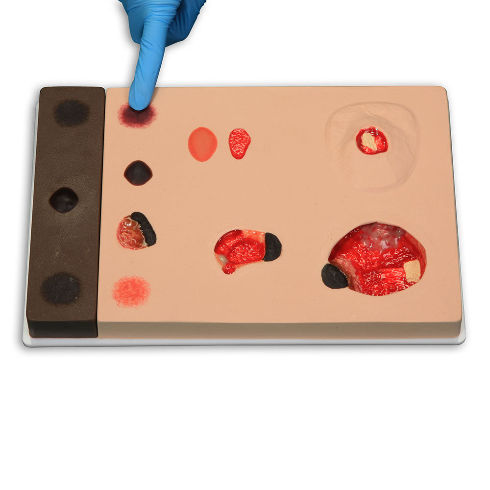 Pat Pressure Injury Staging Model™ – Anchor Simulation