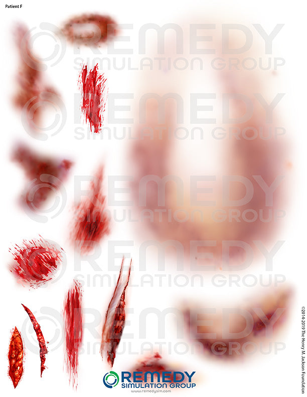 Moulage Tattoo Patient F Scenario – Anchor Simulation