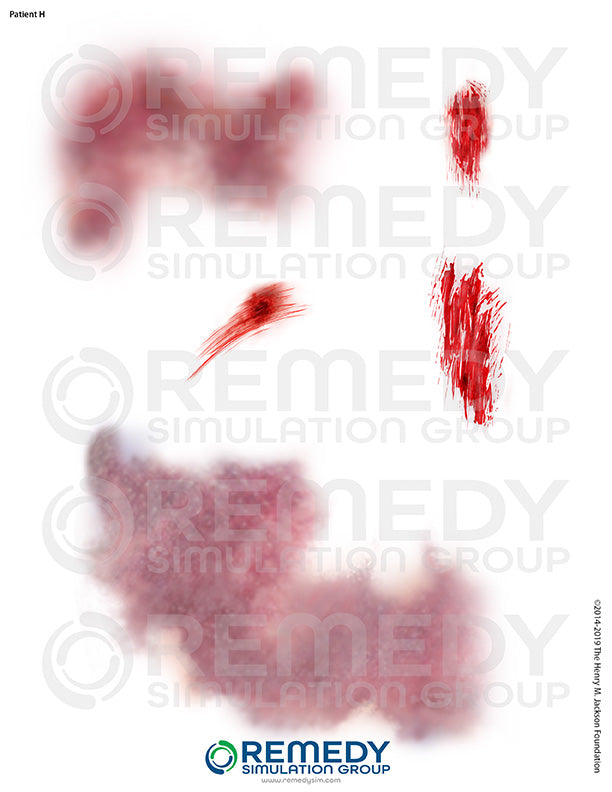Moulage Tattoo Patient H Scenario – Anchor Simulation